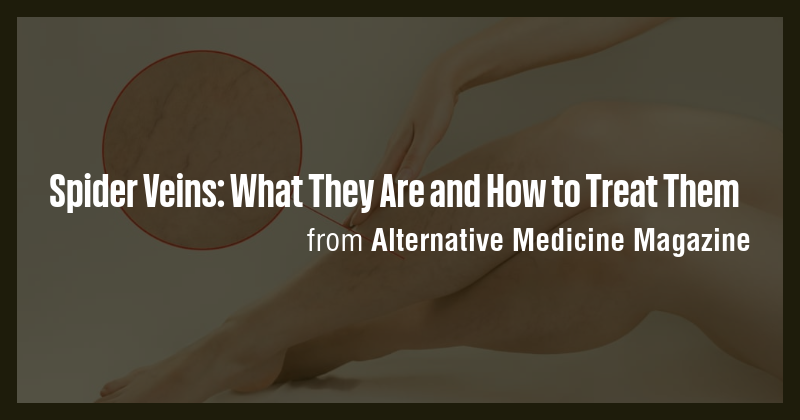 Spider Veins: What They Are and How to Treat Them - Briefly
